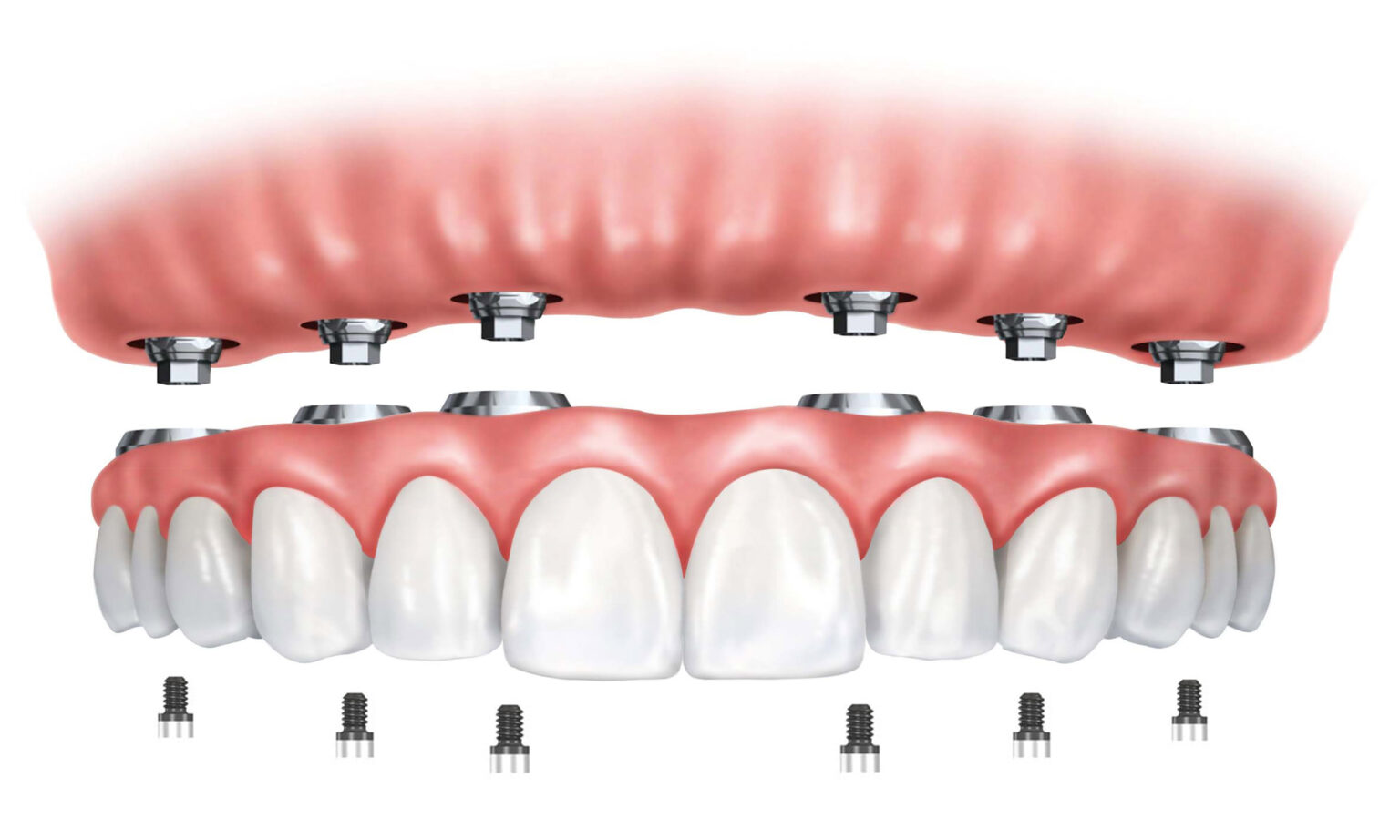 Prothèse Complète Sur Implant , Dentier : notre guide complet sur la ...